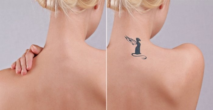 Tattoo Removal: Everything You Need To Know - Best Health N Care